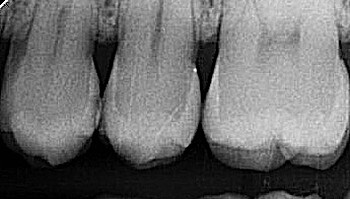 Icon Proximal: Cariësinfiltratie als mild alternatief voor boren